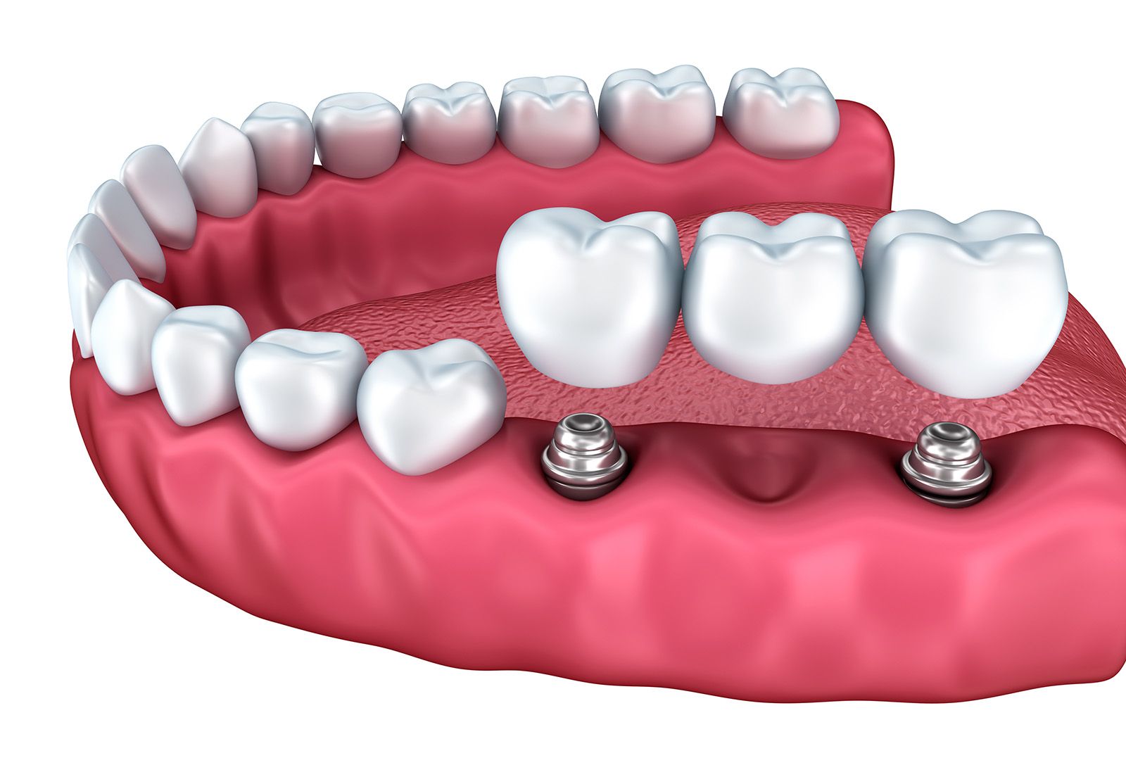 Why Replacing Lost Teeth Is Important? | ZANE DENTAL